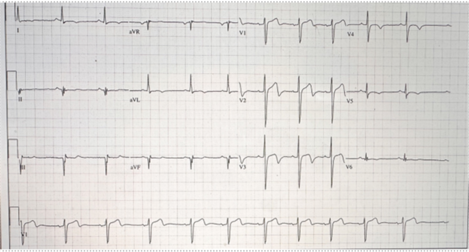 Can You Spot The Killer EKG Finding? | Skin Bones CME